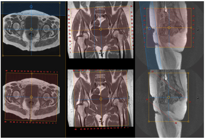 Pelvic Mri Procedure